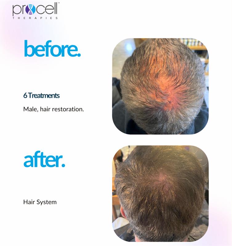 Procell Microchanneling for Hair - Renew Me